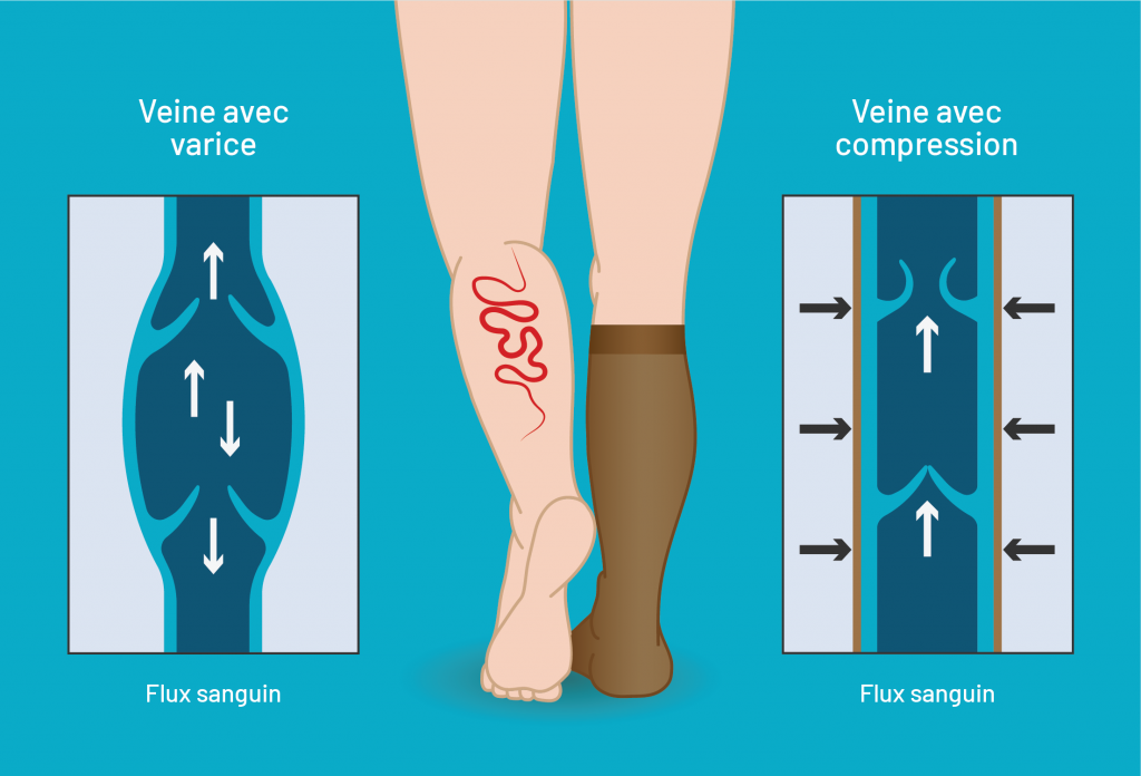 Prévenir les varices, voici comment faire. - Grands Mères