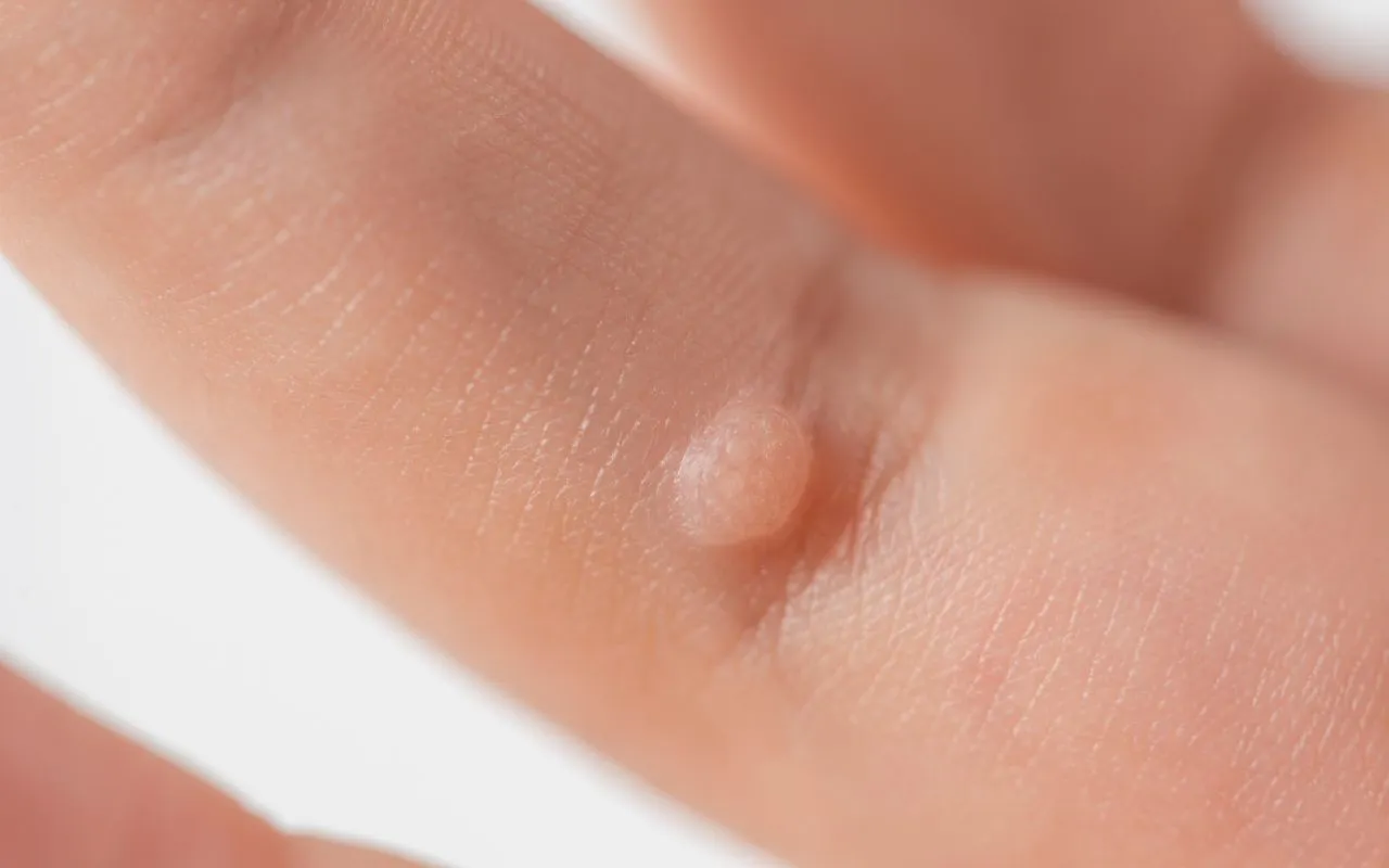 Verrues : Définition, types et traitements ! - Grands Mères