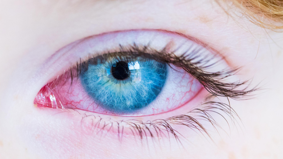 Remèdes naturels efficaces contre les maux d'yeux : Le guide complet ...