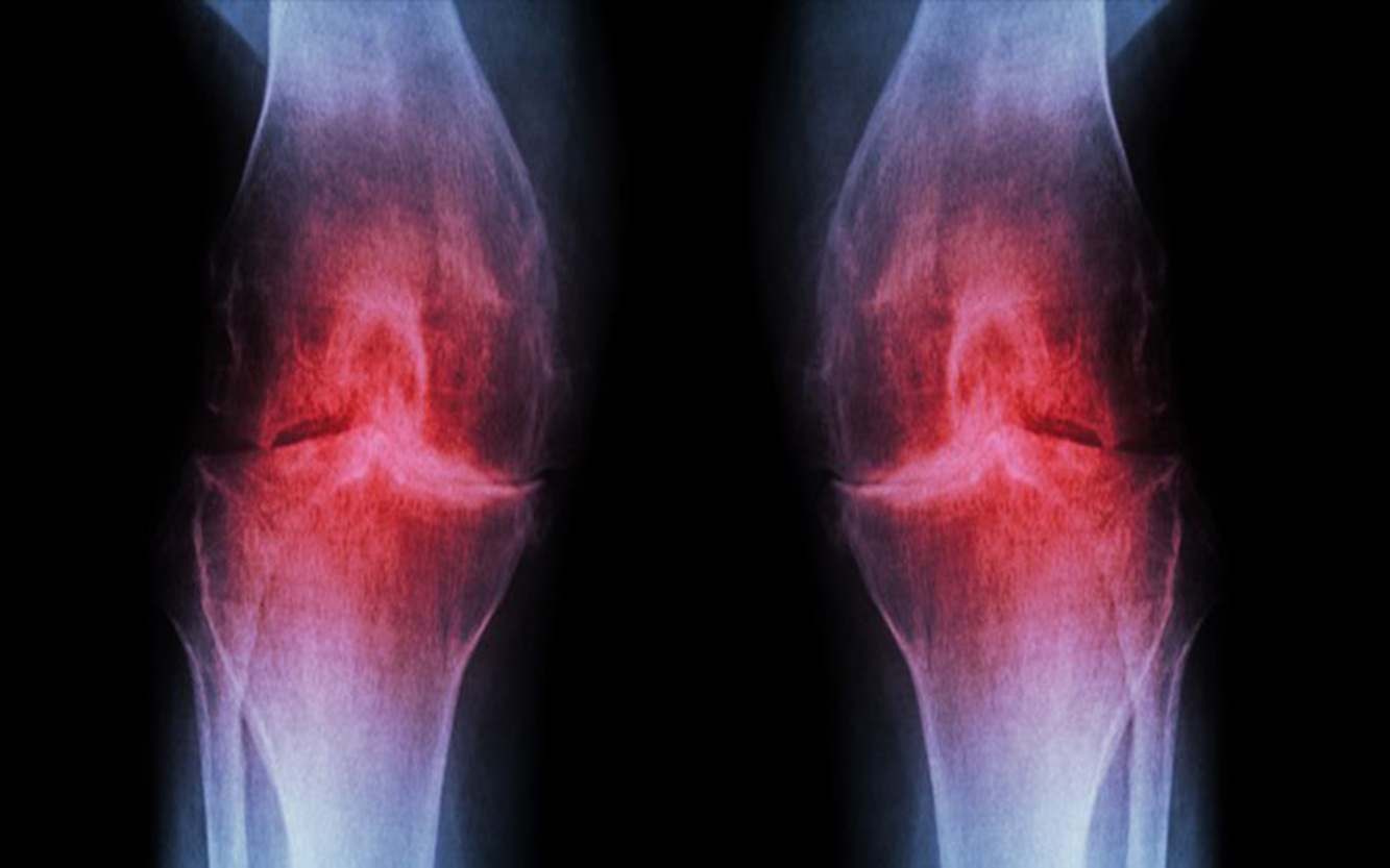 Rhumatismes : Solutions naturelles pour soulager douleurs et raideurs ...